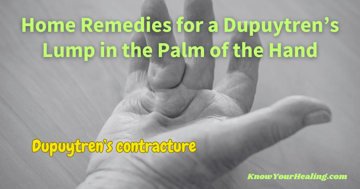 Home remedies for a Dupuytren's lump in the palm of the hand